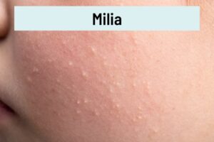White Bumps on Face: Milia and 9 Other Causes