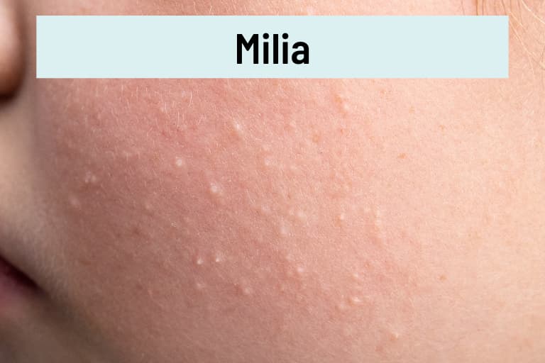 White Bumps On Face Milia And 9 Other Causes