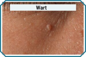 Skin Colored Bumps on Face: 12 Causes, Pictures & Treatment