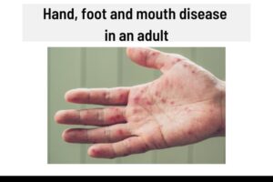 Blisters on Fingers and Hands: 13 Causes, Pictures & Treatment