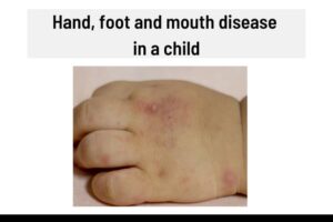 Blisters on Fingers and Hands: 13 Causes, Pictures & Treatment