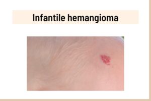 Red Spots on Skin, But Not Itchy: 14 Causes, Pictures, Treatment