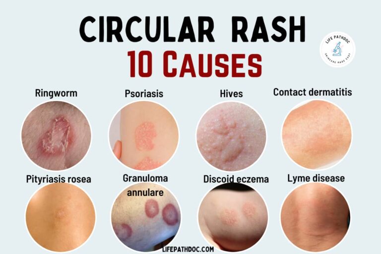10 Causes Of A Circular Rash With Pictures