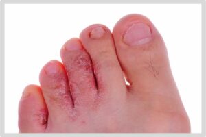 Ringworm Pictures & Symptoms: What does ringworm look like?