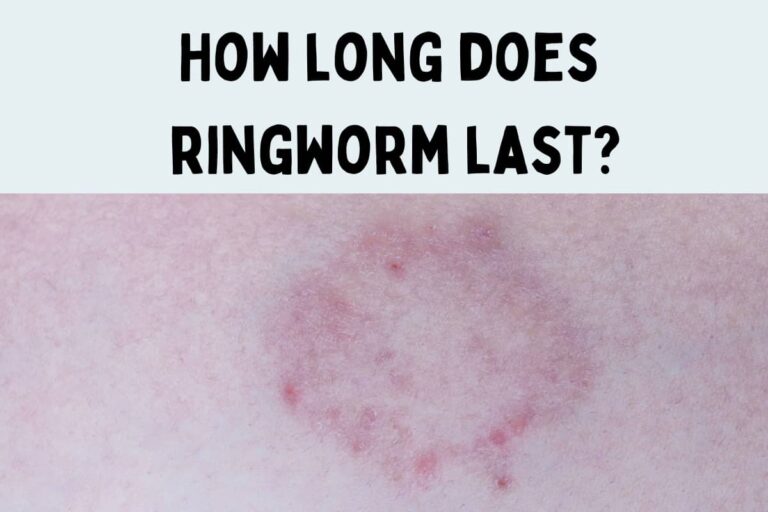 How Long Does Ringworm Last How Long Does Ringworm Last