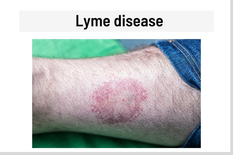 10 Causes Of A Circular Rash With Pictures