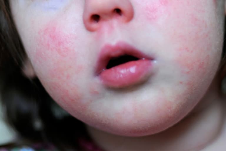 Rash 36 Common Skin Rashes Pictures Causes Treatment