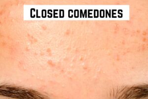 Different Types of Acne (with pictures) & Their Treatment