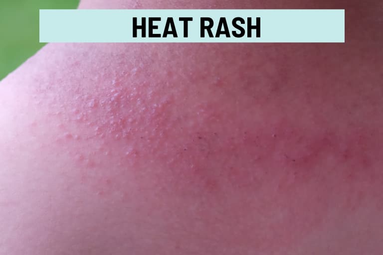 Itchy Bumps On Skin 21 Causes Pictures And Treatment Itchy Bumps On Skin 21 Causes Pictures And Treatment
