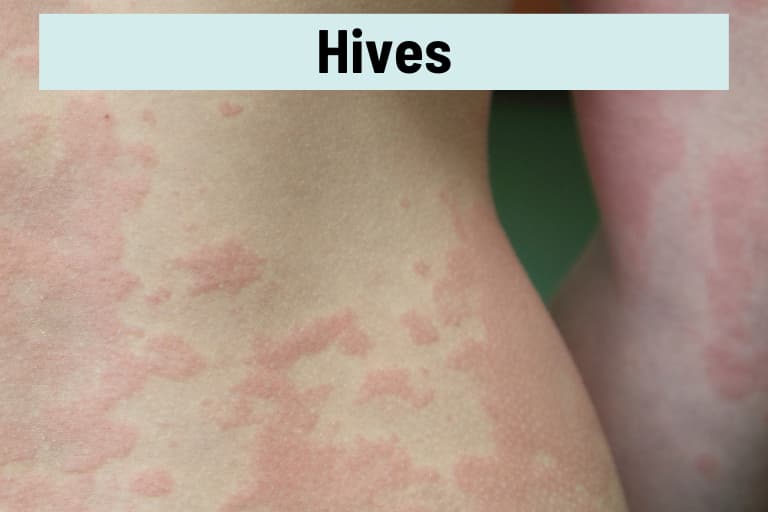 Red Circle On The Skin But Not Itchy Causes Treatment