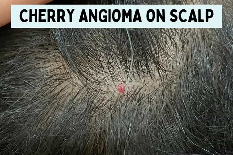 Cherry Angioma On Scalp Cherry Angioma On Scalp