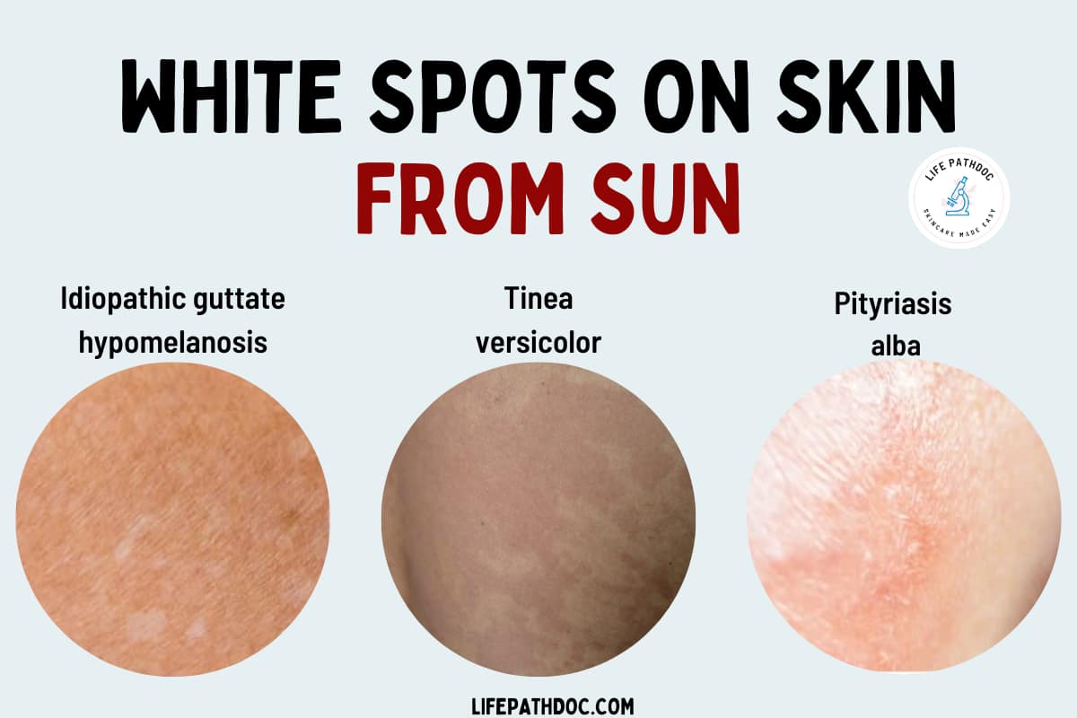 White Spots On Skin From Sun Causes Pictures Treatment