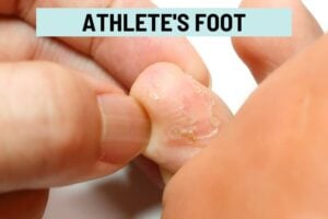 Itchy Blisters on Feet, But Not Athlete's Foot: 11 Causes