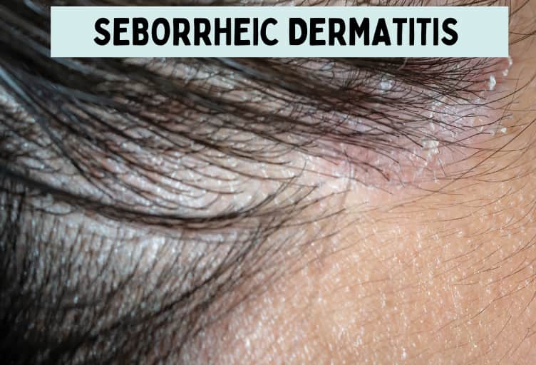 Seborrheic Dermatitis Symptoms Causes Treatments 58 OFF Seborrheic Dermatitis Symptoms Causes Treatments 58 OFF
