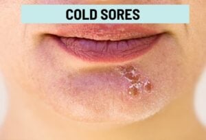 Cold Sores: Pictures of What They Look Like and Symptoms
