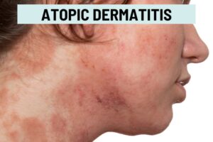 Redness on Face: 23 Causes and How to Reduce It