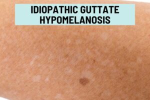 White Spots on Skin: 24 Causes, Pictures, Treatment