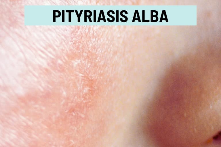 Pityriasis Alba What Causes These Dry White Patches On Skin Pityriasis Alba What Causes These Dry White Patches On Skin