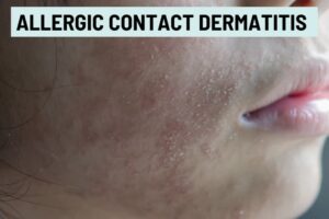 Redness on Face: 23 Causes and How to Reduce It