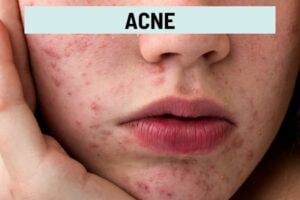 Redness on Face: 23 Causes and How to Reduce It