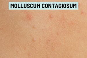 White Spots on Skin: 24 Causes, Pictures, Treatment