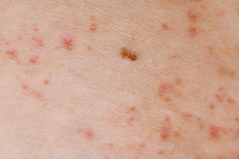 Heat Rash Pictures Symptoms Causes Types And Treatment Heat Rash Pictures Symptoms Causes Types And Treatment
