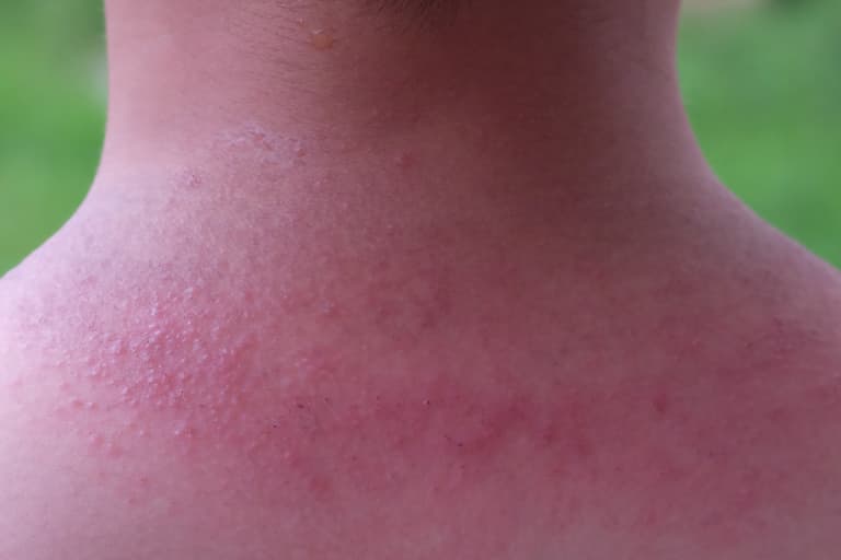 Heat Rash Pictures Symptoms Causes Types And Treatment Heat Rash Pictures Symptoms Causes Types And Treatment