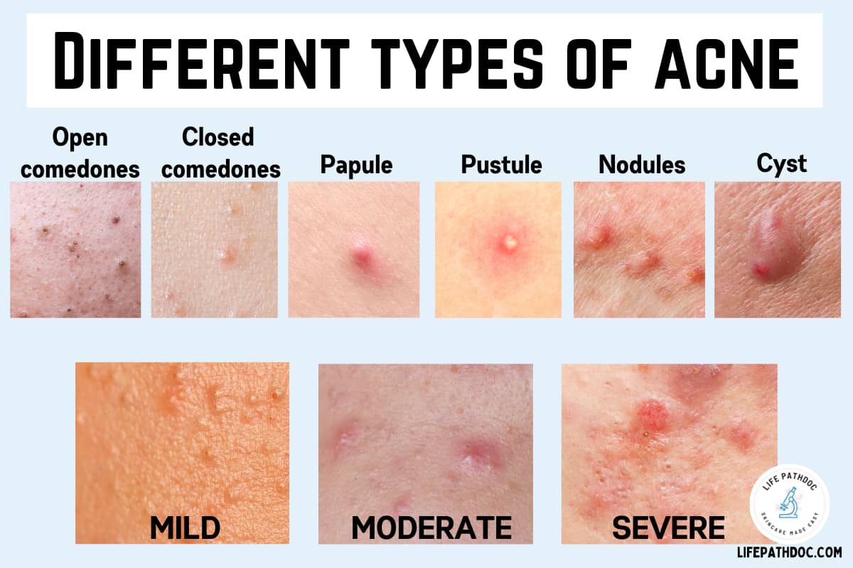 Different Types Of Acne with Pictures Their Treatment Different Types Of Acne with Pictures Their Treatment