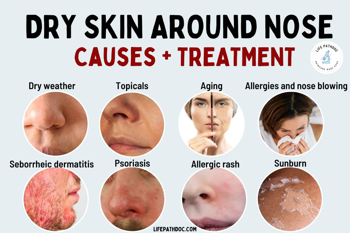 Skin Rash Around Nose And Mouth Infoupdate