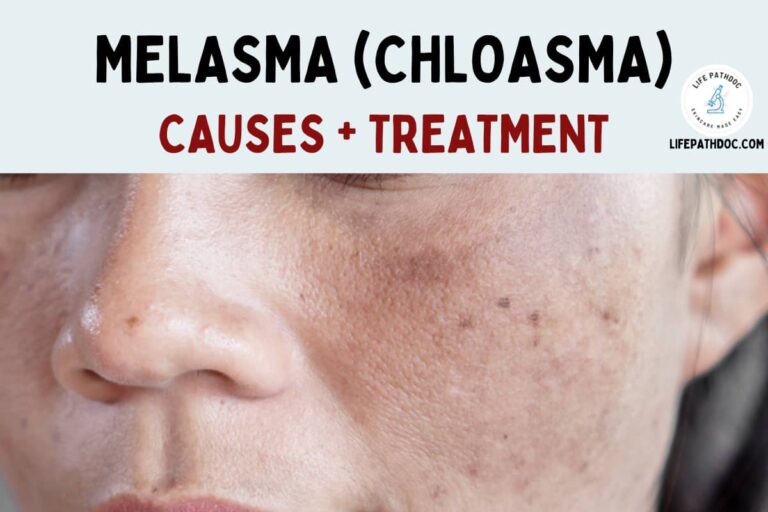 Melasma: Treatment & Causes of These Dark Patches on Face