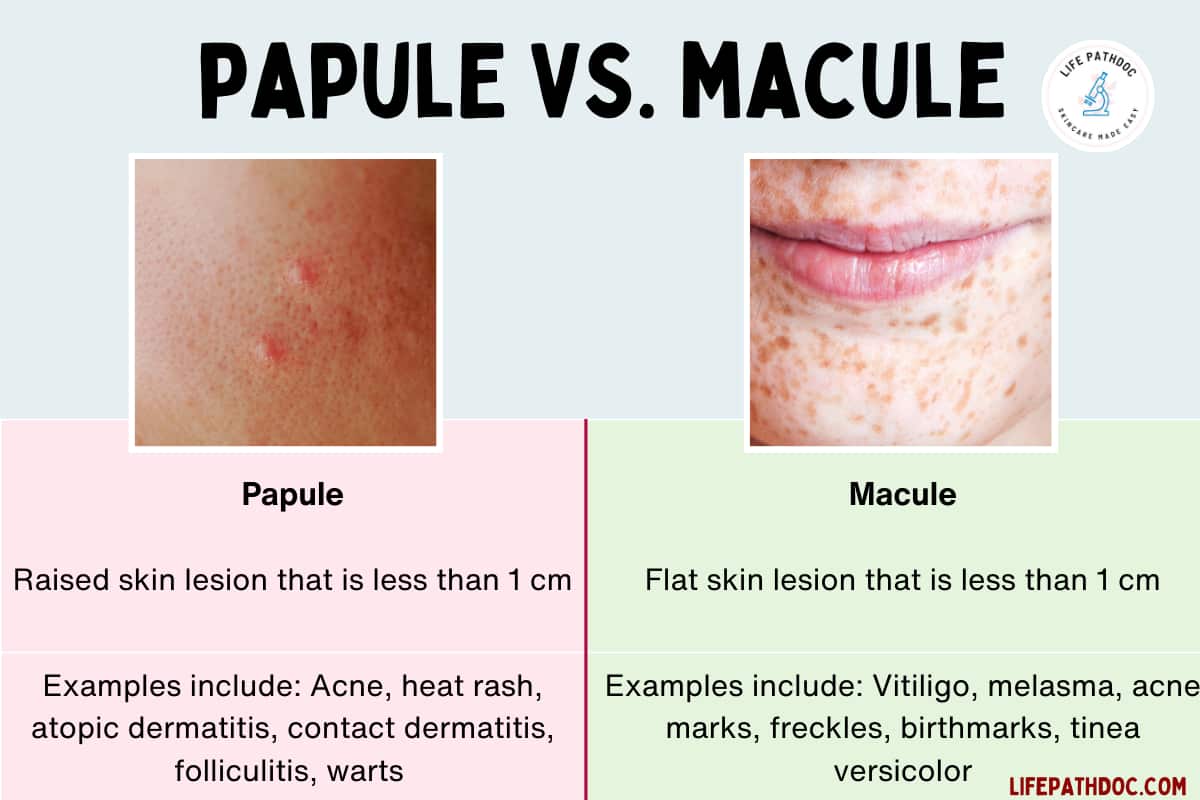 Macular Rash Macular Rash