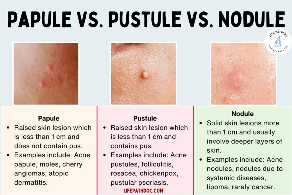 Papule Vs Pustule Vs Nodule Pictures Differences And Causes Papule Vs Pustule Vs Nodule Pictures Differences And Causes