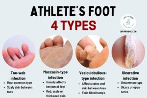 Athlete’s Foot: Pictures, Types, Symptoms, Causes & Treatment