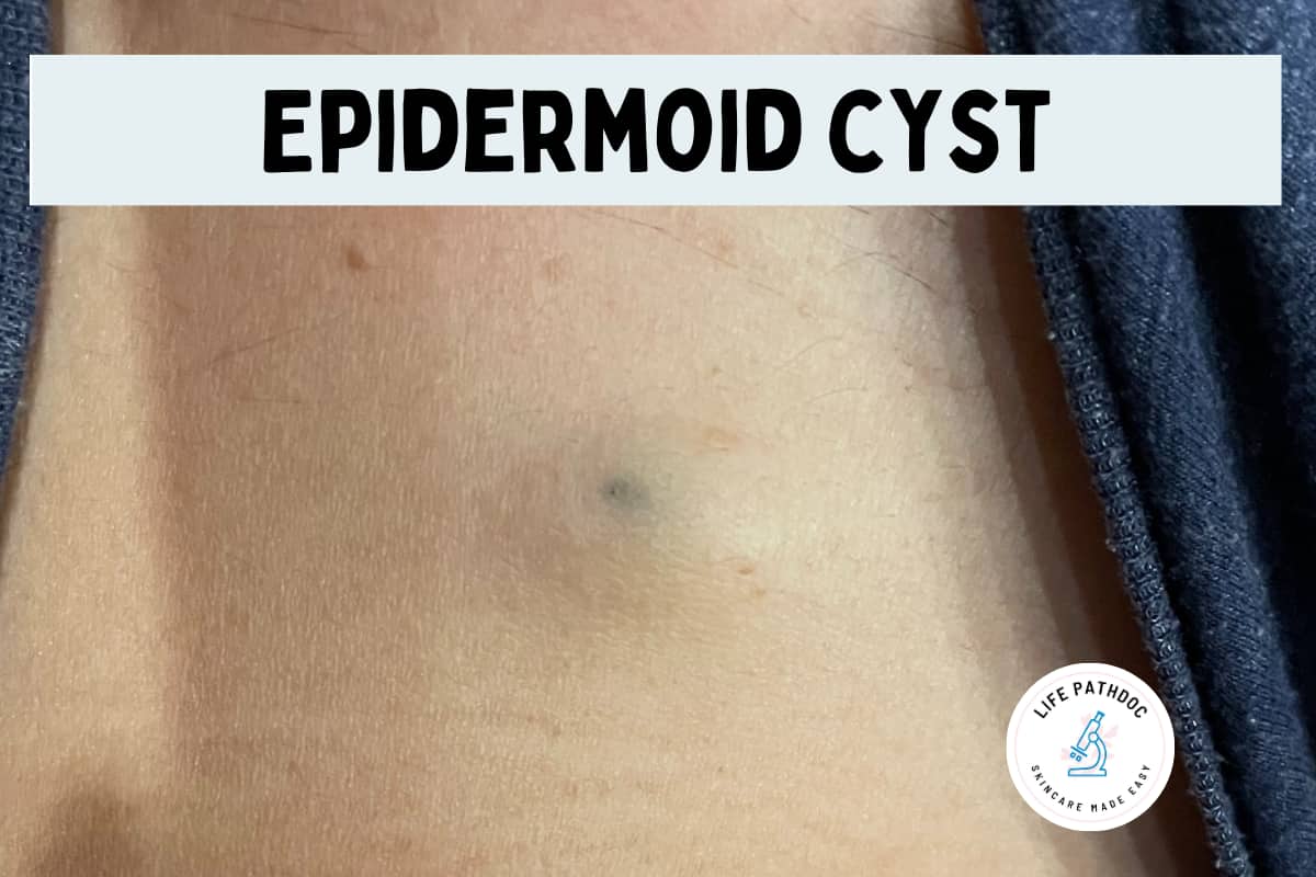 Epidermoid Cyst EIC Causes Pictures Removal Epidermoid Cyst EIC Causes Pictures Removal