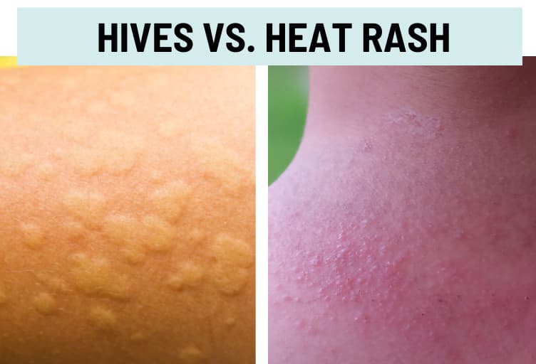 Hives Urticaria Vs Rash Pictures And Differences Hives Urticaria Vs Rash Pictures And Differences