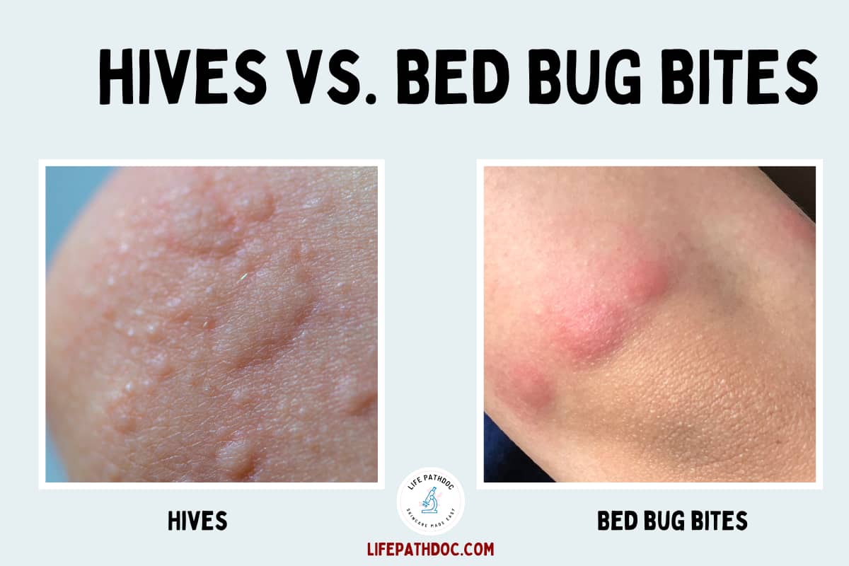 Do Bed Bugs Give You Hives At Francis Manley Blog Do Bed Bugs Give You Hives At Francis Manley Blog