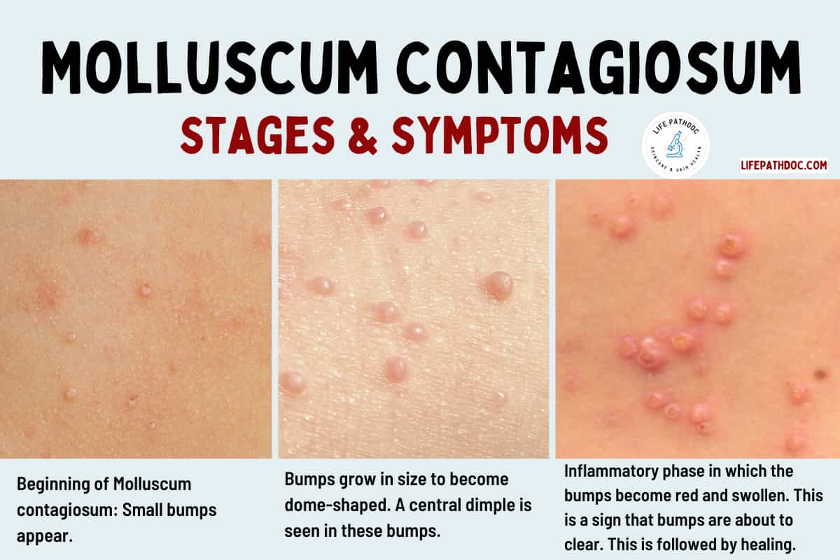 Molluscum Contagiosum Pictures Stages Symptoms Causes Molluscum Contagiosum Pictures Stages Symptoms Causes